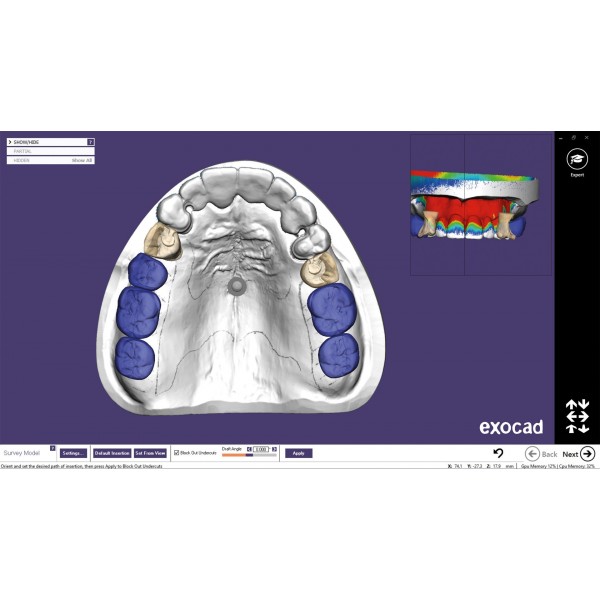 PartialCAD Module of EXOCAD DentalCAD 3D Design Software