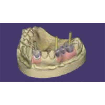 EXOCAD DentalCAD 3D Design Software Implant Module